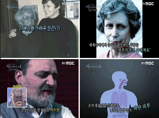 스머프인간 희귀병 유전 약물 부작용으로 생겨 민중의소리